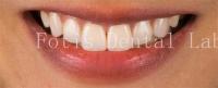 China High End Cosmetic Teeth Veneers For Perfect Smile Stain Resistance for sale