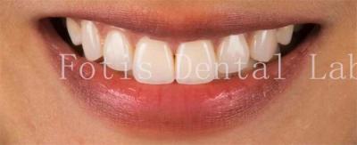 China High End Cosmetic Teeth Veneers For Perfect Smile Stain Resistance for sale