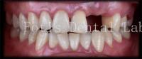 China Customised Natural Temporary Dental Veneers For A Beautiful Smile for sale