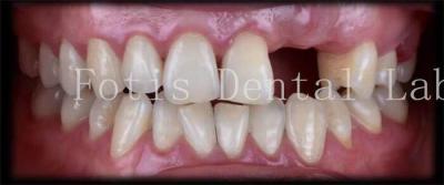 China Customised Natural Temporary Dental Veneers For A Beautiful Smile for sale