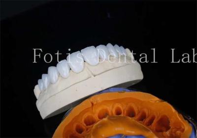 China Porcelain Dental Lab Laminate Veneers 0.3-0.5mm Bonding Cement for Long Lasting Restorations for sale
