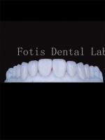 China Dental Porcelain Veneers 0.3-0.5mm High Translucency Custom Cosmetic Teeth Covers for sale