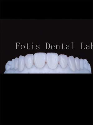 China Dental Porcelain Veneers 0.3-0.5mm High Translucency Custom Cosmetic Teeth Covers for sale
