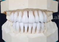 China Dental Lab Laminate Veneers 0.3-0.5mm Porcelain High Strength Bonding Cement for sale