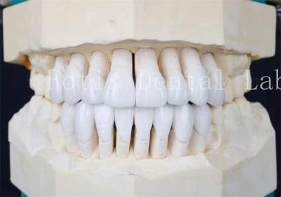 China Dental Lab Laminate Veneers 0.3-0.5mm Porcelain High Strength Bonding Cement for sale