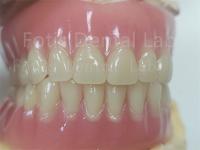 China Comfort Custom Fit Full Acrylic Denture For Precise Dental Prosthesis for sale