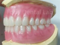 China Customizable Full Acrylic Denture with Ivoclar Teeth Stain Resistant Natural Color for sale