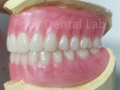 China Customizable Full Acrylic Denture with Ivoclar Teeth Stain Resistant Natural Color for sale