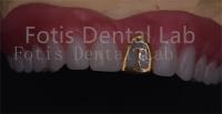 China OEM Full Acrylic Denture Set Ivoclar Teeth Stain Resistant Natural Color for sale