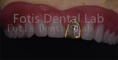 China OEM Full Acrylic Denture Set Ivoclar Teeth Stain Resistant Natural Color for sale