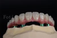 China All on 4 All on 6 Dental Implants Full Arch Zirconia Bridge 4 or 6 Implants for sale