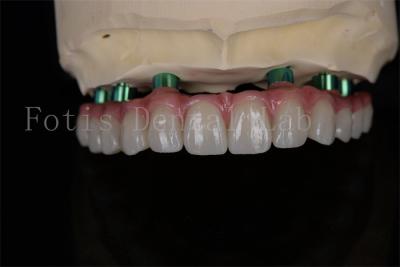 China All on 4 All on 6 Implant Dentures Zirconia Bridge Titanium 4 or 6 Implants Same Day Procedure for sale