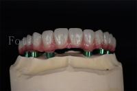 China All on 4 All on 6 Dental Implants with Zirconia Bridge 4 or 6 Implants High Success Rate for sale