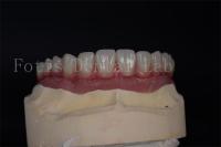China Natural Aesthetics with Affordable All on 4 All on 6 Implants for sale