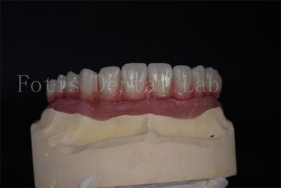 China Natural Aesthetics with Affordable All on 4 All on 6 Implants for sale