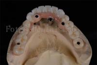 China All-on-4 All-on-6 Implant Dentures Same Day Full Chewing Restoration Titanium Zirconia for sale