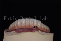China All on 4 All on 6 Dental Implants Titanium Zirconia Full Arch Bridge Natural Looking for sale