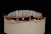 China Affordable Natural Looking 4 Or 6 Implants Full Arch Success Rate Minimally Invasive Solution for sale