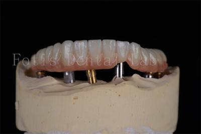 China Affordable Natural Looking 4 Or 6 Implants Full Arch Success Rate Minimally Invasive Solution for sale