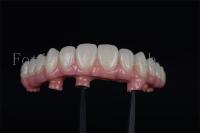 China Natural looking Full Chewing Ability Restoration with 4 Or 6 Implants for sale
