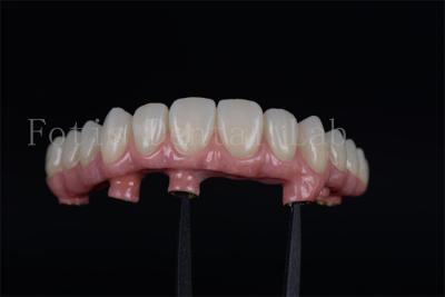 China Natural looking Full Chewing Ability Restoration with 4 Or 6 Implants for sale