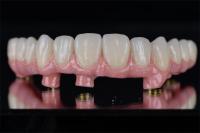 China All on 4 All on 6 Dental Implants Full Arch Zirconia Bridge Restores Chewing for sale