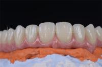 China All on 4 All on 6 Dental Implants Full Arch Zirconia Bridge 1-2 Week Recovery for sale
