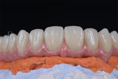 China All on 4 All on 6 Dental Implants Full Arch Zirconia Bridge 1-2 Week Recovery for sale