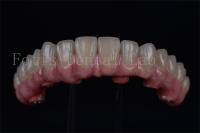 China All on 4 All on 6 Full Arch Implants Titanium Zirconia Bridge Same Day Procedure 4 or 6 Implants for sale