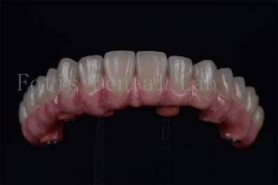 China All on 4 All on 6 Full Arch Implants Titanium Zirconia Bridge Same Day Procedure 4 or 6 Implants for sale