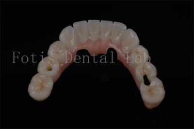 China Natural Looking All On Four Teeth In A Day For Any Age Available for sale