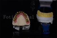 China All on 4 All on 6 Dental Implants Titanium Zirconia Full Arch Bridge for sale