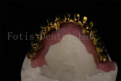 China Natural Looking All On 4 All On 6 Dental Implants Restores Full Chewing Ability for sale