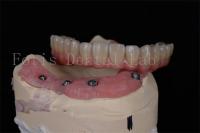 China Customizable All on 4 All on 6 Dental Implants Titanium Full Arch Bridge for sale