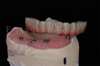 China Customizable All on 4 All on 6 Dental Implants Titanium Full Arch Bridge for sale