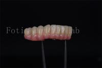 China All on 4 All on 6 Dental Implant System Same Day Teeth Replacement 4 or 6 Implants for sale
