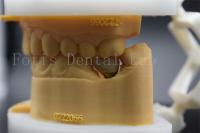 China Dental Lab Implant Crowns Titanium Zirconia PFM High Precision Fit Long Lasting for sale