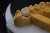 China Titanium / PFM Denture Crown Customizable Zirconia Implant Crown Durable for sale