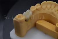 China Dental Lab Implant Crowns Titanium Zirconia PFM for Missing Tooth Restoration for sale