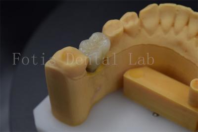 China Dental Lab Implant Crowns Titanium Zirconia PFM for Missing Tooth Restoration for sale