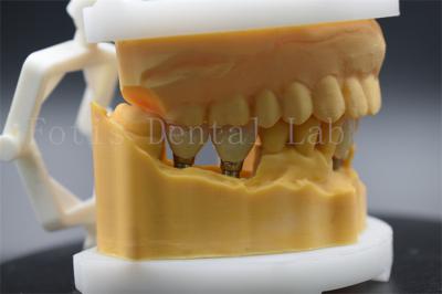 China Precision Titanium Dental Implant Crown for Tooth Restoration Easy Clean for sale
