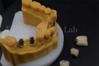 China Dental Lab Implant Crowns High Precision Fit Restoration of Missing Teeth Various Sizes Available for sale