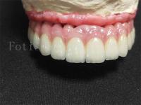 China Zirconia Implant Crown Polished Finish Dental Prosthetic Crown for Missing Tooth Restoration for sale