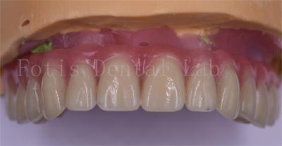 China Custom Polished Titanium Zirconia PFM Dental Implant Crown High Precision Fit for sale