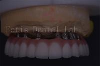 China Customizable Silver Dental Crown Precision Fit For Comfortable Restoration for sale