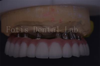 China Customizable Silver Dental Crown Precision Fit For Comfortable Restoration for sale