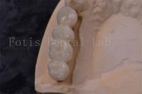 China Dental Lab Implant Crowns High Precision Fit Zirconia PFM Crown Easy Clean for sale