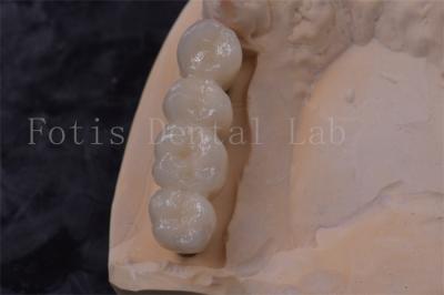 China Dental Lab Implant Crowns High Precision Fit Zirconia PFM Crown Easy Clean for sale