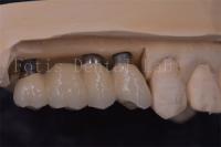 China Dental Lab Implant Crowns Titanium Zirconia PFM High Precision Fit for Missing Teeth Restoration for sale