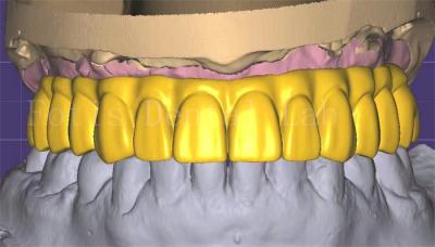 China Dental Design 3Shape Crown Software for Jaw Reconstruction and Implant Planning for sale